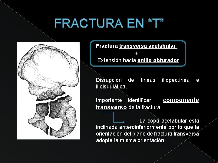 Fracturas Acetabulares Clasificacin y valor del TCMD Leire