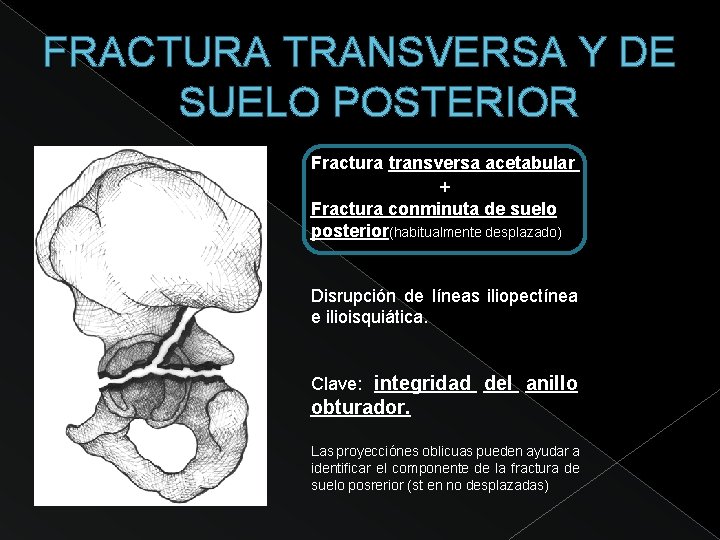 Fracturas Acetabulares Clasificacin y valor del TCMD Leire