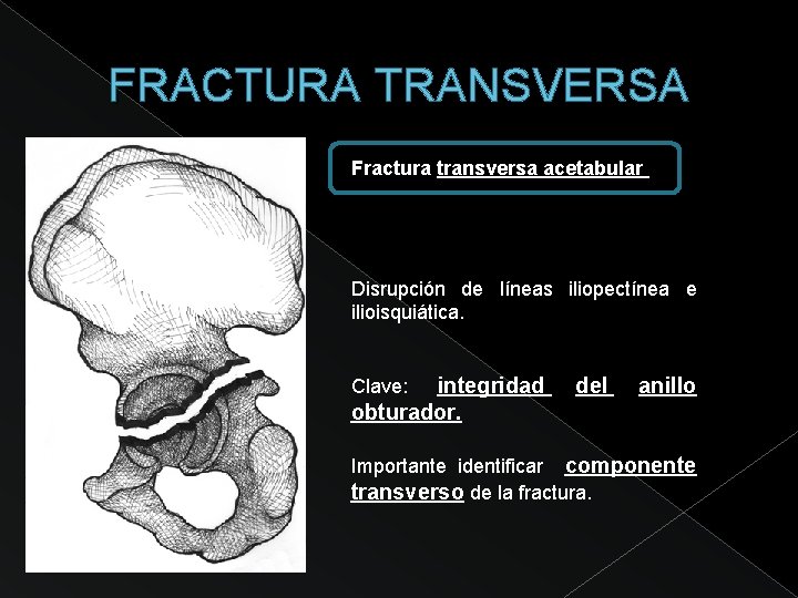 Fracturas Acetabulares Clasificacin y valor del TCMD Leire
