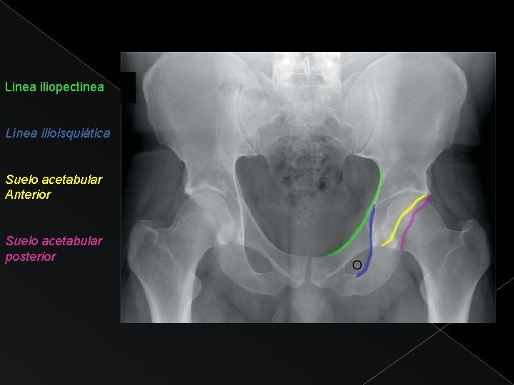 Fracturas Acetabulares Clasificacin y valor del TCMD Leire