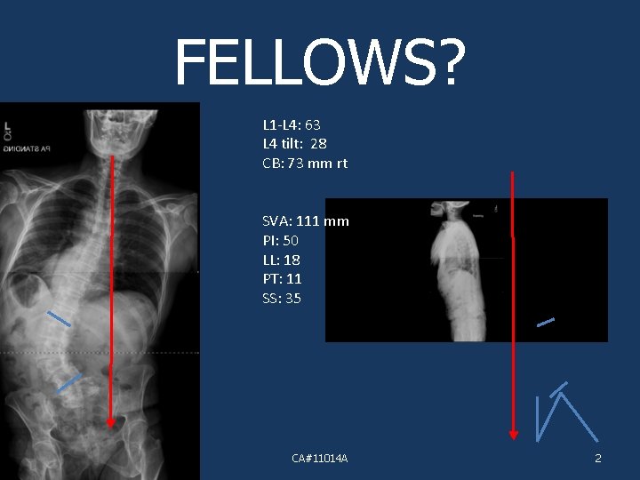 1 Key measurements for understanding spinal deformity Greg