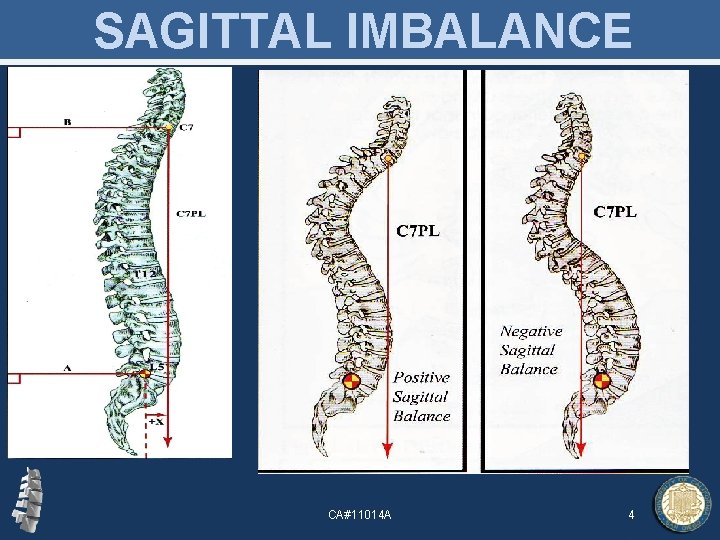 1 Key measurements for understanding spinal deformity Greg