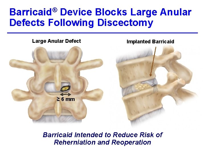 CO1 Reherniation and Reoperation in Lumbar Discectomy Impact