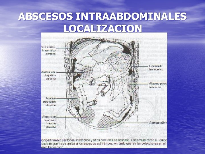 SEPSIS ABDOMINAL CAVIDAD ABDOMINAL PERITONEO PARIETAL VISCERAL EPIPLON