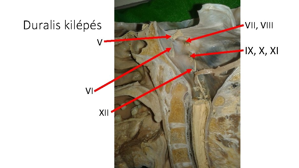 Nervus trigeminus Trigeminus neuralgia OK 2018 10 24