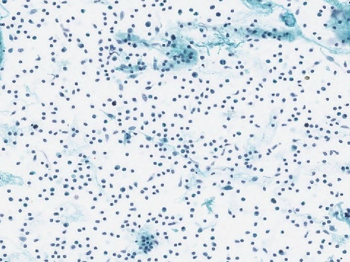 High cellularity Dissociated pattern Tumor cell Variable shapeovoid