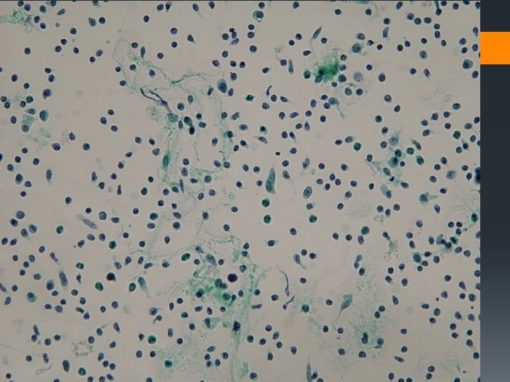 High cellularity Dissociated pattern Tumor cell Variable shapeovoid