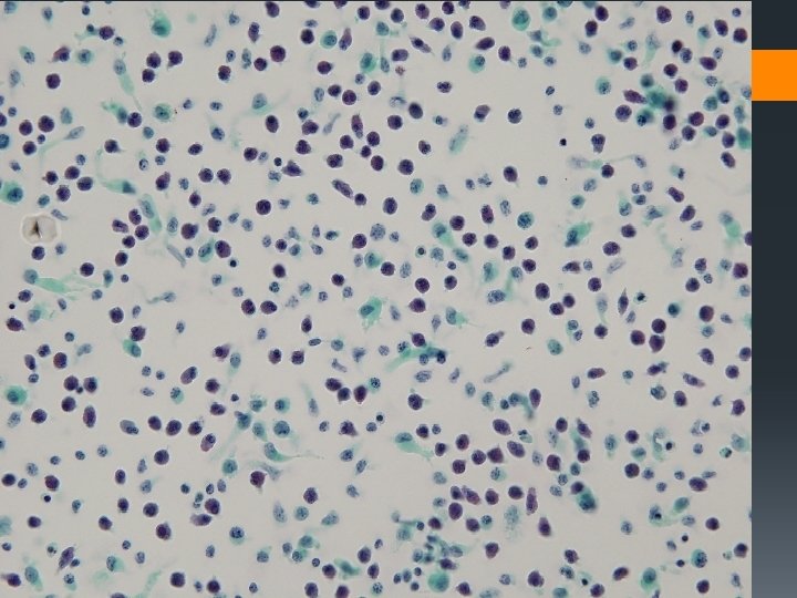 High cellularity Dissociated pattern Tumor cell Variable shapeovoid