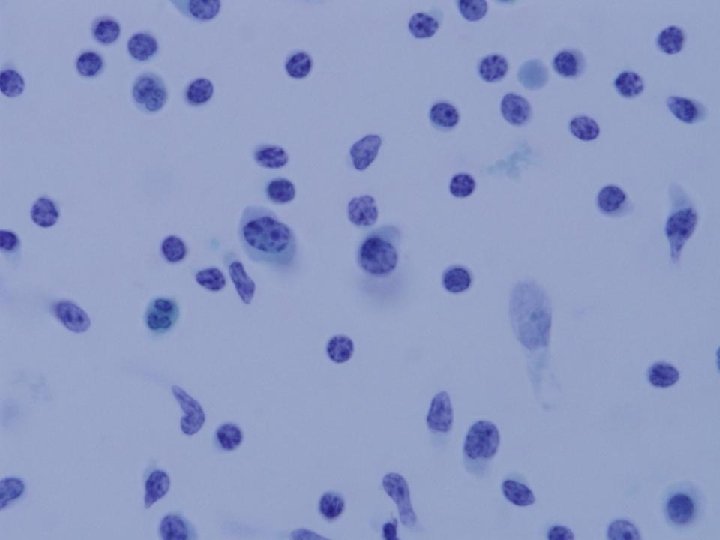 High cellularity Dissociated pattern Tumor cell Variable shapeovoid