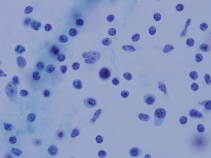 High cellularity Dissociated pattern Tumor cell Variable shapeovoid