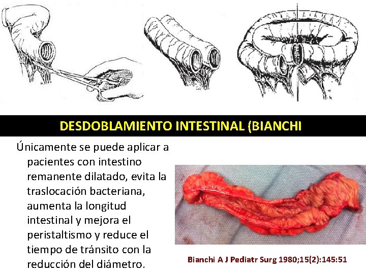Sndrome de intestino corto TRATAMIENTO QUIRRGICO Acad Dr