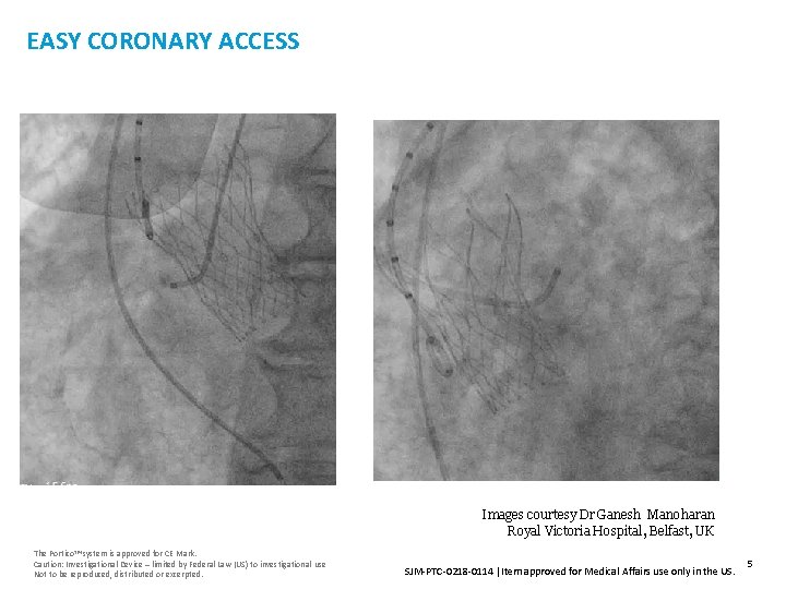 2018 GLOBAL PORTICO PROGRAM UPDATE Portico Transcatheter Aortic