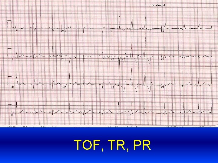 A Practical Approach to Paediatric ECG Interpretation on
