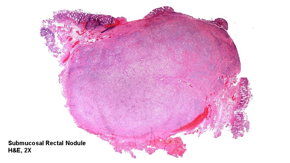 Extranodal RosaiDorfman Disease of the Rectum EAHP 16