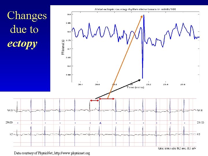 HRV 2006 Ectopic Beats Activity Effects and Heart