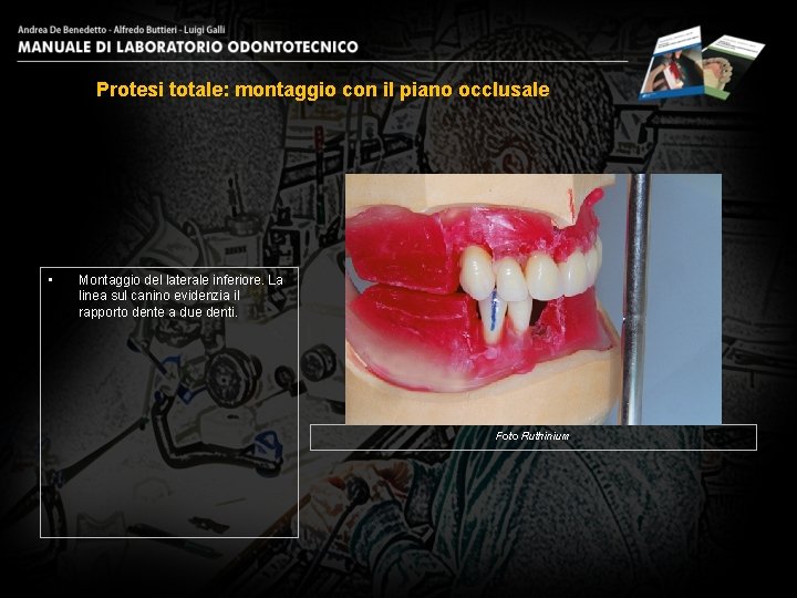 Protesi totale montaggio con il piano occlusale Vallo