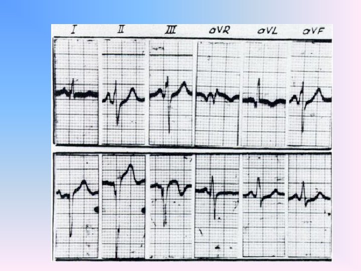 Standardization Interpretation of ECG Dr Frijo Jose A