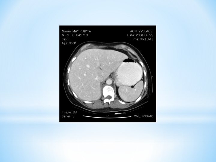 HEPAR Facies diaphragmatica pars superior area nuda pars