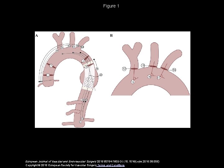 Aortic Arch Morphology and Aortic Length in Patients