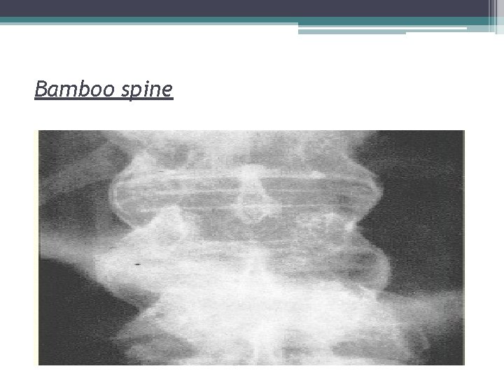 Spondyloarthropathies Spondyloarthropathias include the following ...