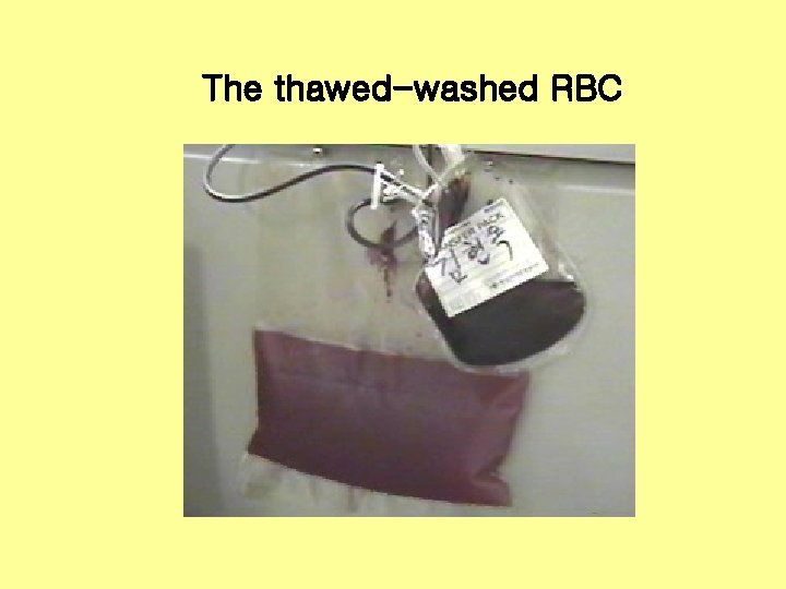 Methods of RBC Cryopreservation Consideration Highconcentration ...