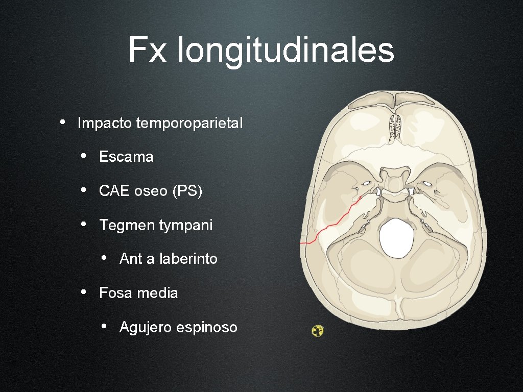 Fracturas del Hueso Temporal Evaluacin y manejo Carlos
