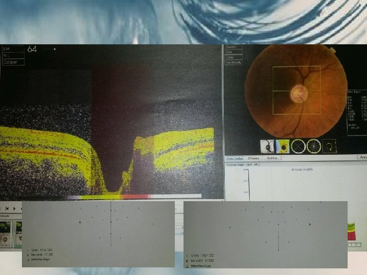 Sndrome de PosnerSchlossmann Reporte retrospectivo de casos Ponente