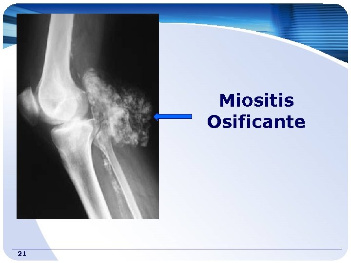 COMPLICACIONES DE LAS LESIONES TRAUMTICAS DEL SOMA Dr