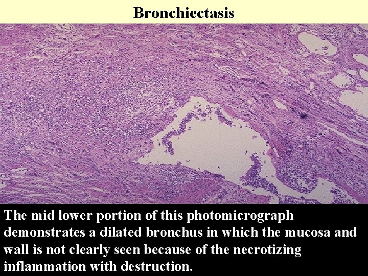Bronchiectasis DR AYSER HAMEED LEC 4 Bronchiectasis Is