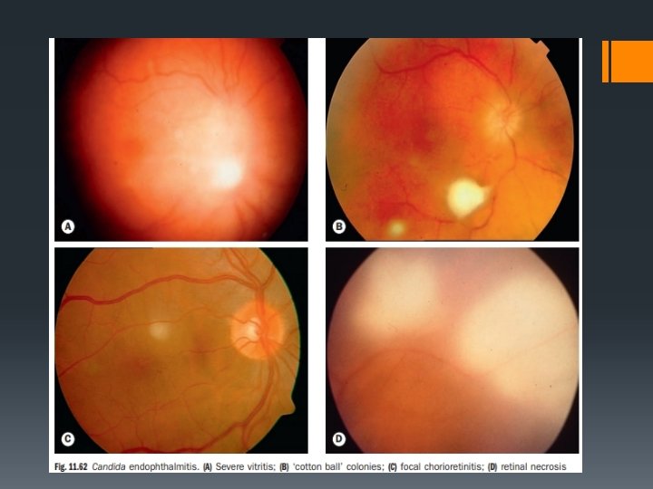 INFECTIVE UVEITIS DR P PRADEEP PROFESSOR DEPARTMENT OF