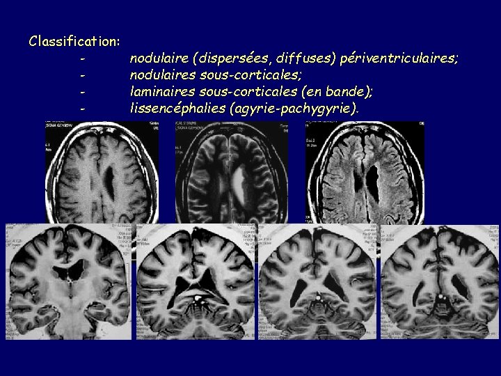 MALFORMATIONS CEREBRALES Dr TLILIGRAIESS K Master Neuroradiologie Sousse