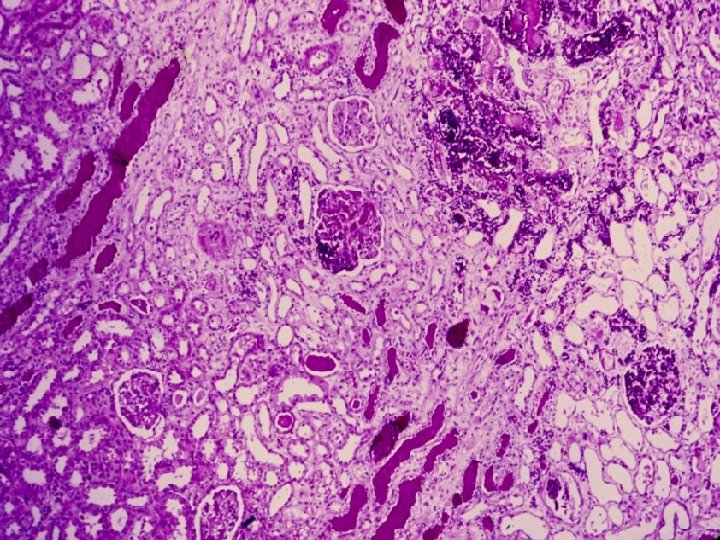 Pathology of Kidney and the Urinary tract Dr