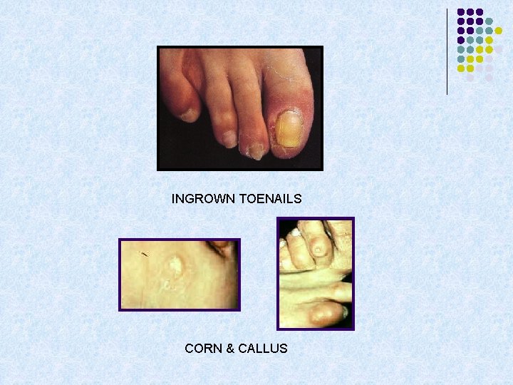 DIABETIC FOOT CARE BAGIAN ILMU KEDOKTERAN FISIK DAN