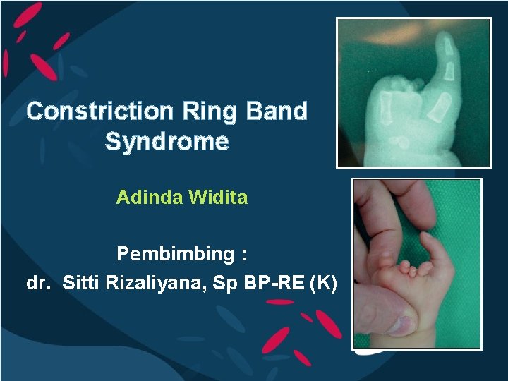 Constriction Ring Band Syndrome Adinda Widita Pembimbing dr