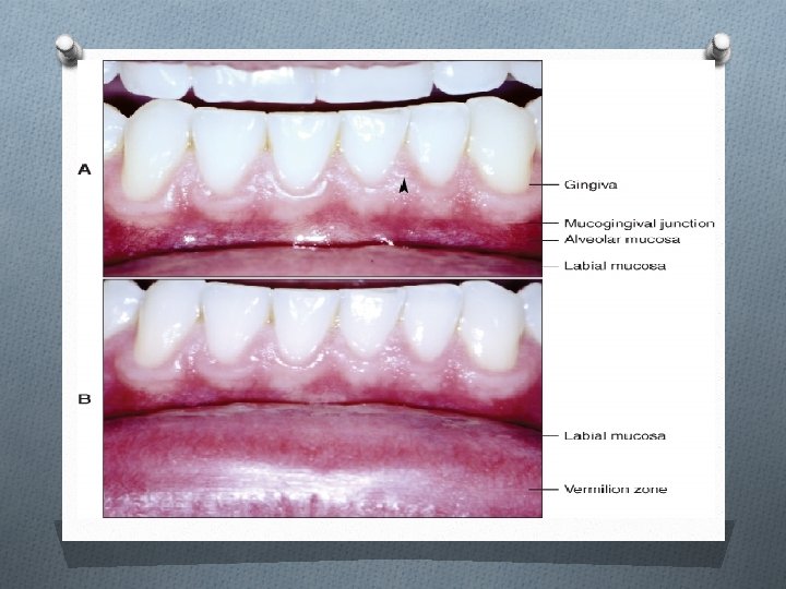 Oral Mucous Membrane O Mucous Membrane Moist lining