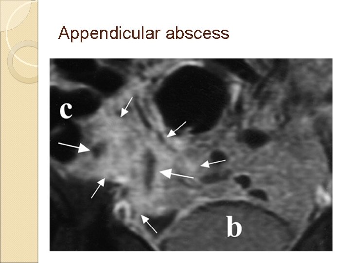 Difficult Appendesectomy In Surgical Practice Introduction 1889 Mac