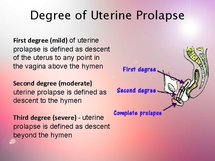 Uterine Prolapse Uterine prolapse dropped uterus is a
