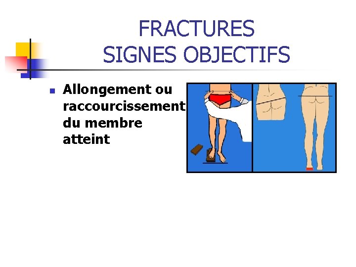 SEMIOLOGIE DES FRACTURES ENTORSES ET LUXATIONS SEMIOLOGIE ORTHOPEDIQUE