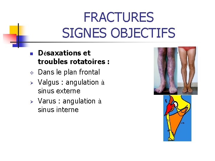 SEMIOLOGIE DES FRACTURES ENTORSES ET LUXATIONS SEMIOLOGIE ORTHOPEDIQUE