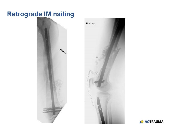 Management of distal femoral fractures moderated interactive session