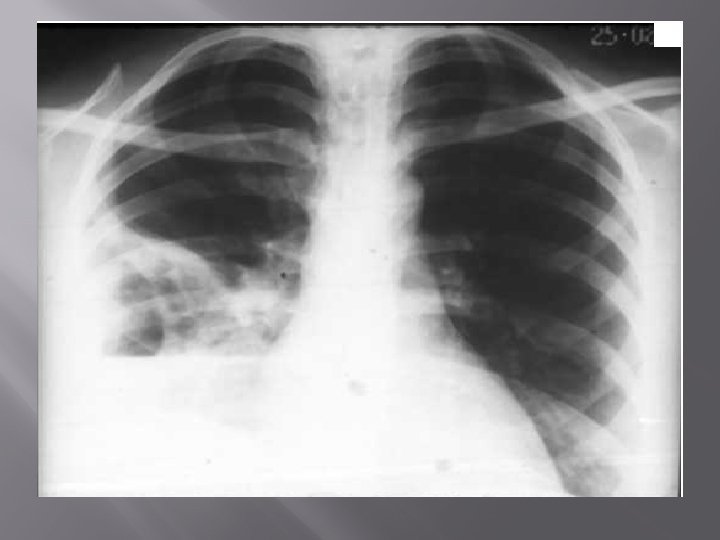 BRONCOASPIRACION SINDROME DE MENDELSON Curtis L Mendelson 1946