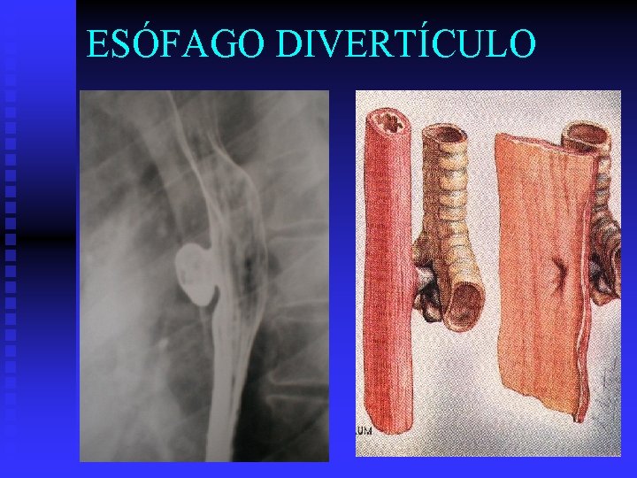 PATOLOGA QUIRRGICA DEL ESFAGO DR JOS A MAINIERI