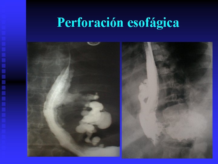 PATOLOGA QUIRRGICA DEL ESFAGO DR JOS A MAINIERI