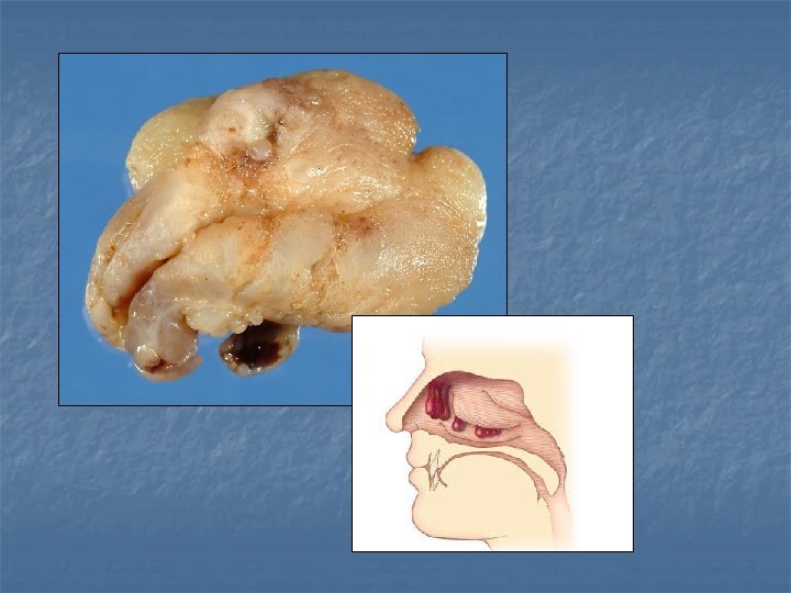 Benign sinonasal neoplasms and tumorlike lesions Prof Alena