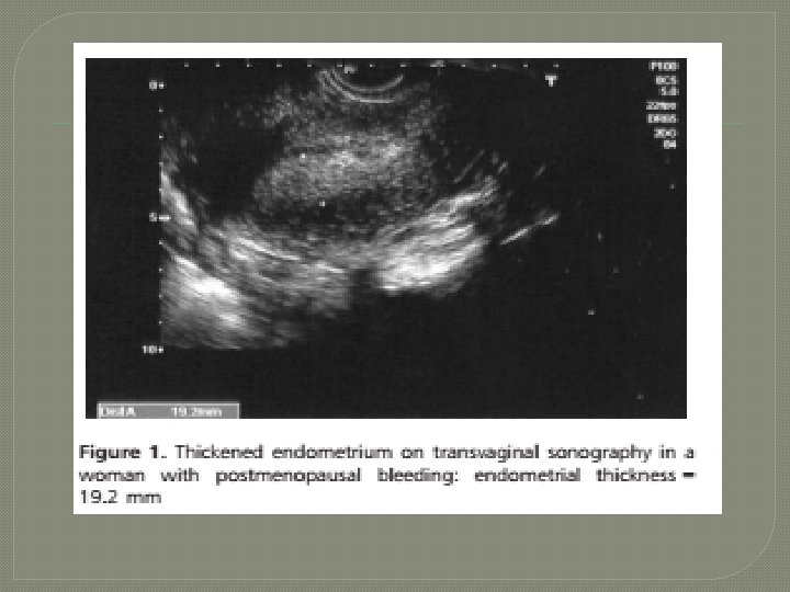 AUB Abnormal uterine bleeding during perimenopause and post