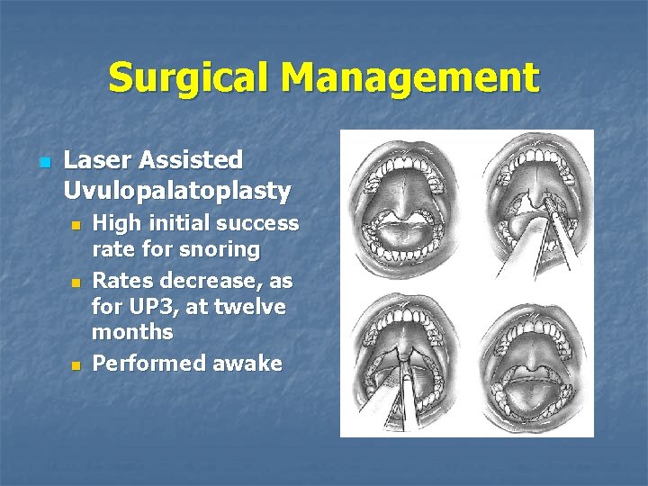 Surgical Management of Obstructive Sleep Apnea Marilene B