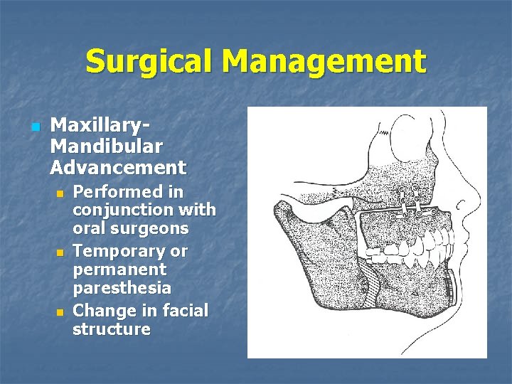 Surgical Management of Obstructive Sleep Apnea Marilene B