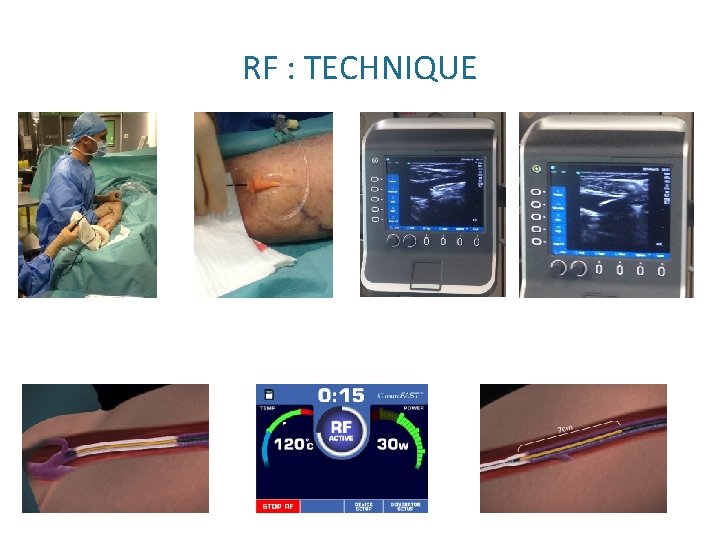 PRISE EN CHARGE MINIINVASIVE DES VARICES PAR RADIOFREQUENCE