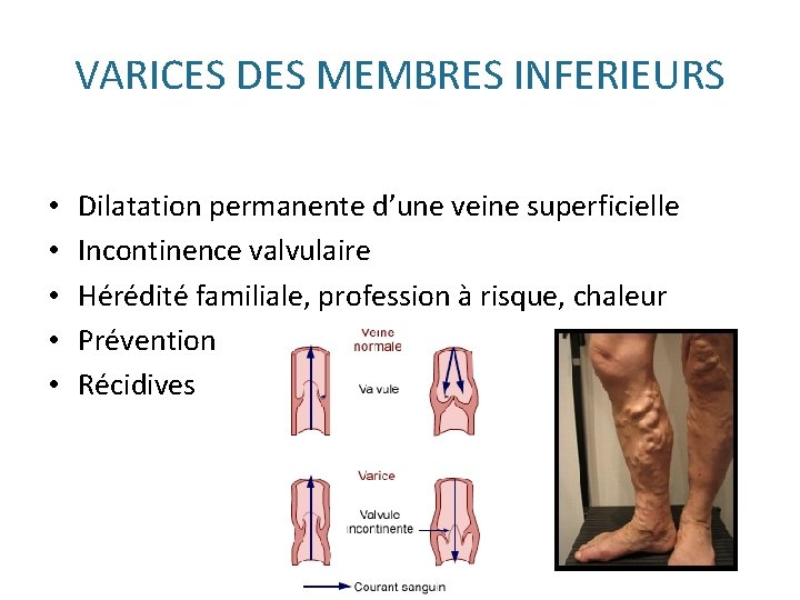PRISE EN CHARGE MINIINVASIVE DES VARICES PAR RADIOFREQUENCE