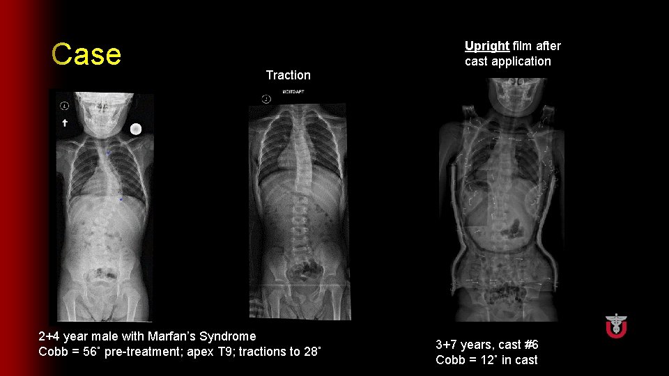 What Is The Role for Elongation Derotation Flexion